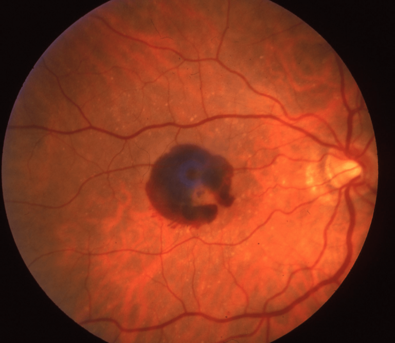 Eye Diseases, Cataracts, Glaucoma, Diabetes | Wilmington Family Eye Care