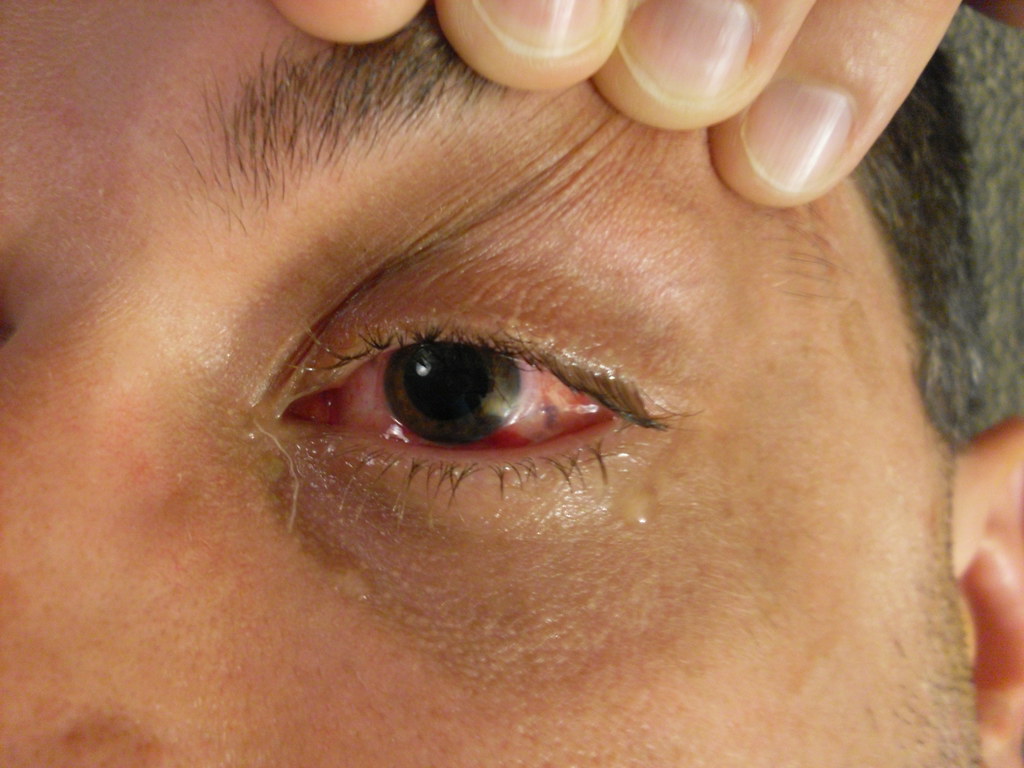 What Is the Difference Between Conjunctivitis and Pink Eye?