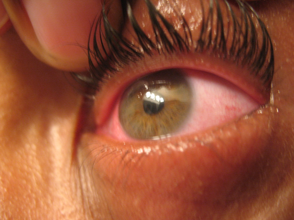 What Does a Scratch on the Eye Feel Like?